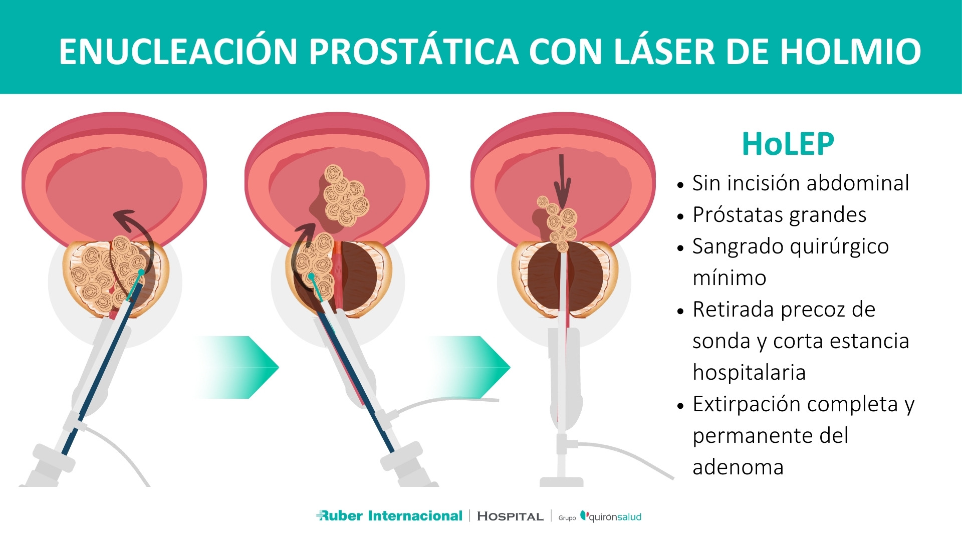 Hiperplasia benigna de próstata: tratamiento mediante enucleación con láser de holmio